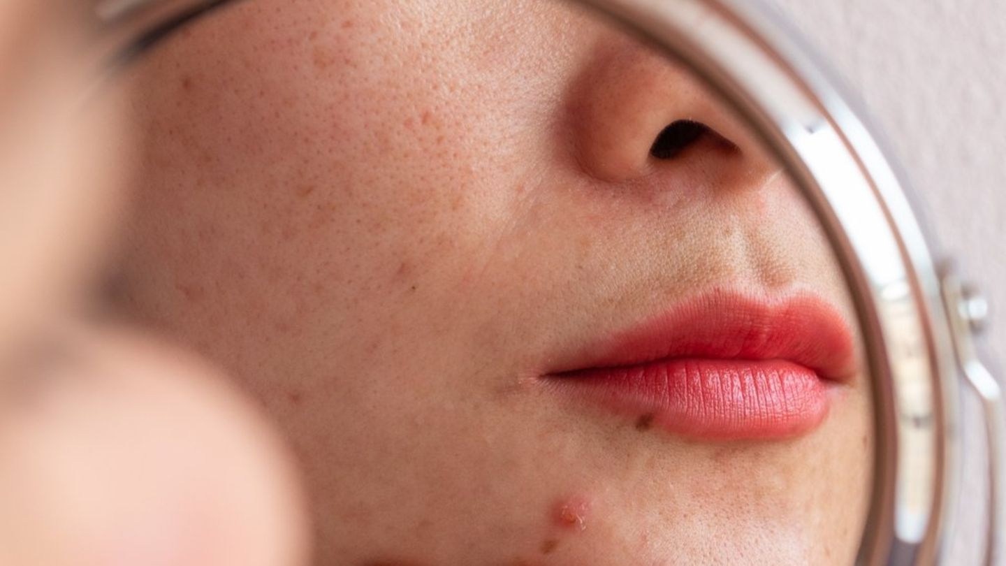 Adult Acne Causes Solutions And Treatment Options Archyde